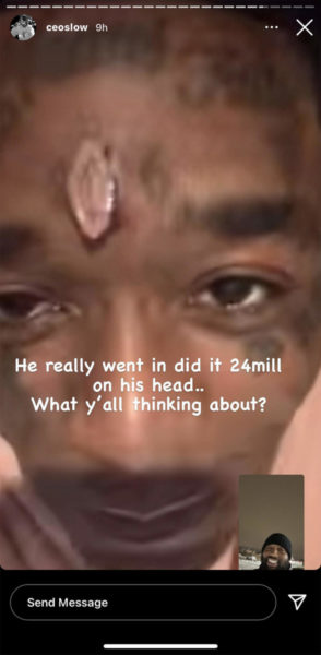 Lil Uzi Vert implants a $24 million diamond in his forehead